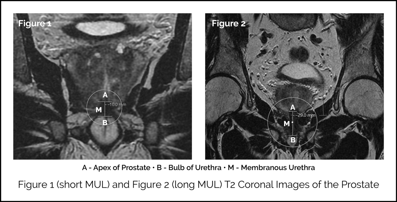 Robotic Assisted Radical Prostatectomy - Declan Cahill
