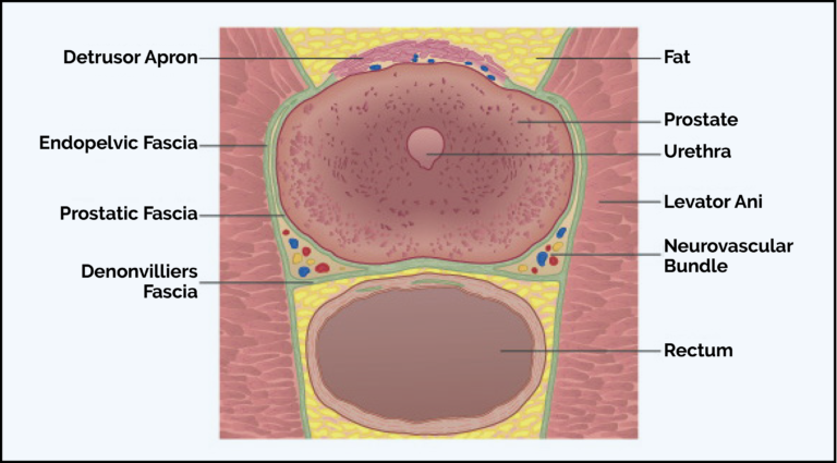 Robotic Assisted Radical Prostatectomy - Declan Cahill